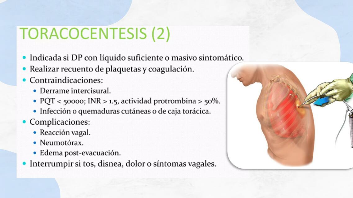 Toracocentesis | Alxnsx s | uDocz