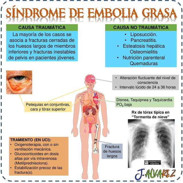 Síndrome de embolia grasa | Jovy Alvarez | uDocz