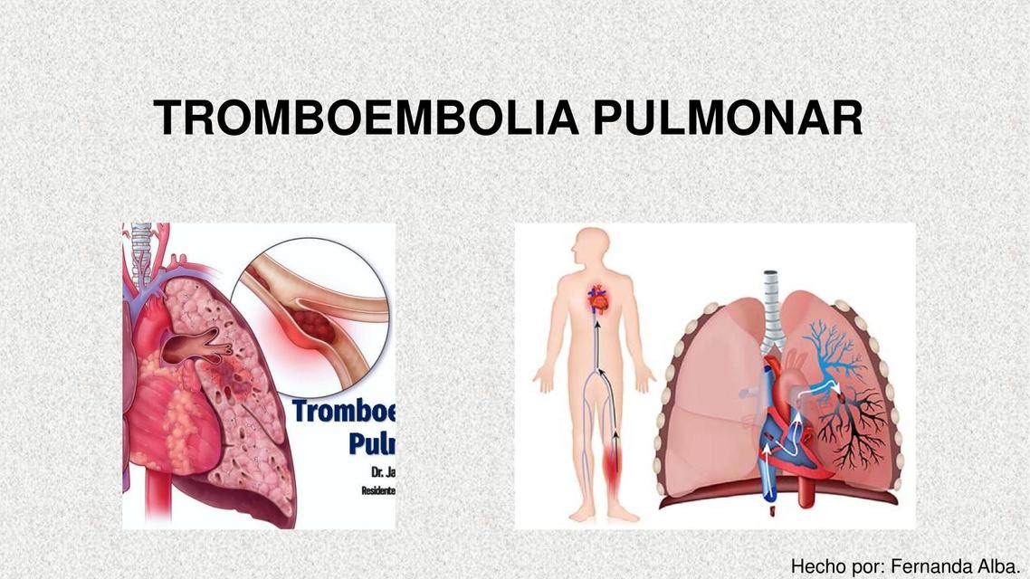 TROMBOEMBOLIA PULMONAR por fernanda alba | FernandaAlbaa | uDocz