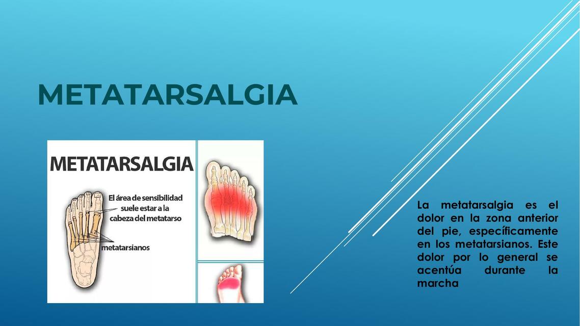 Metatarsalgia | B.M.GFisioterapia Apuntes y demás | uDocz
