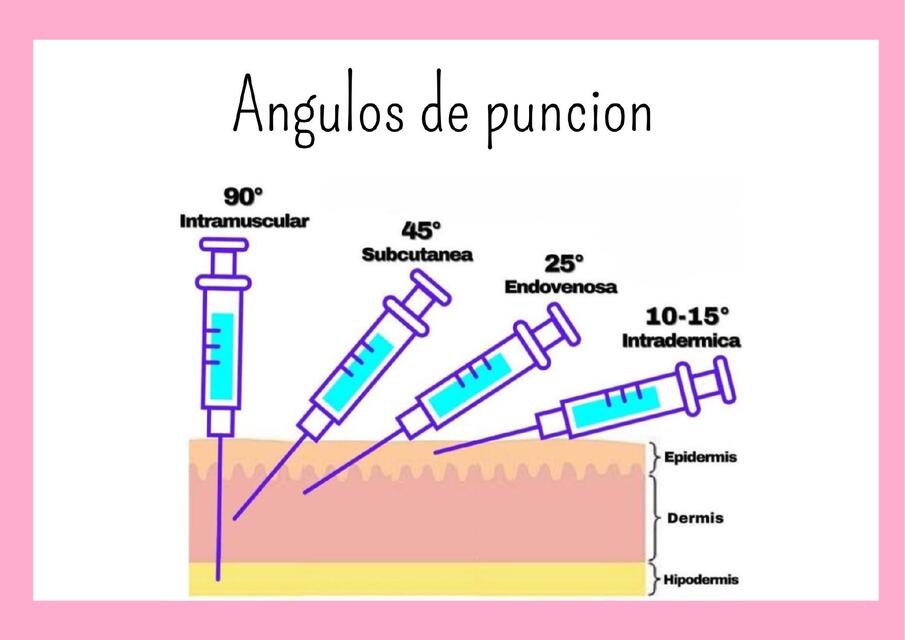 Ángulos de punción | Tens IQ | uDocz