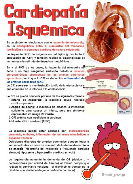 Cardiopatía isquémica | medi_fer | uDocz