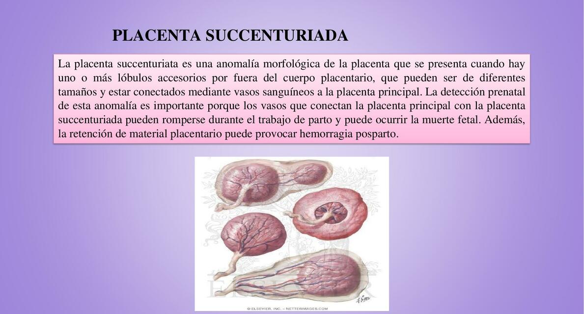 PLACENTA SUCCENTURIADA | Escuela medica | uDocz