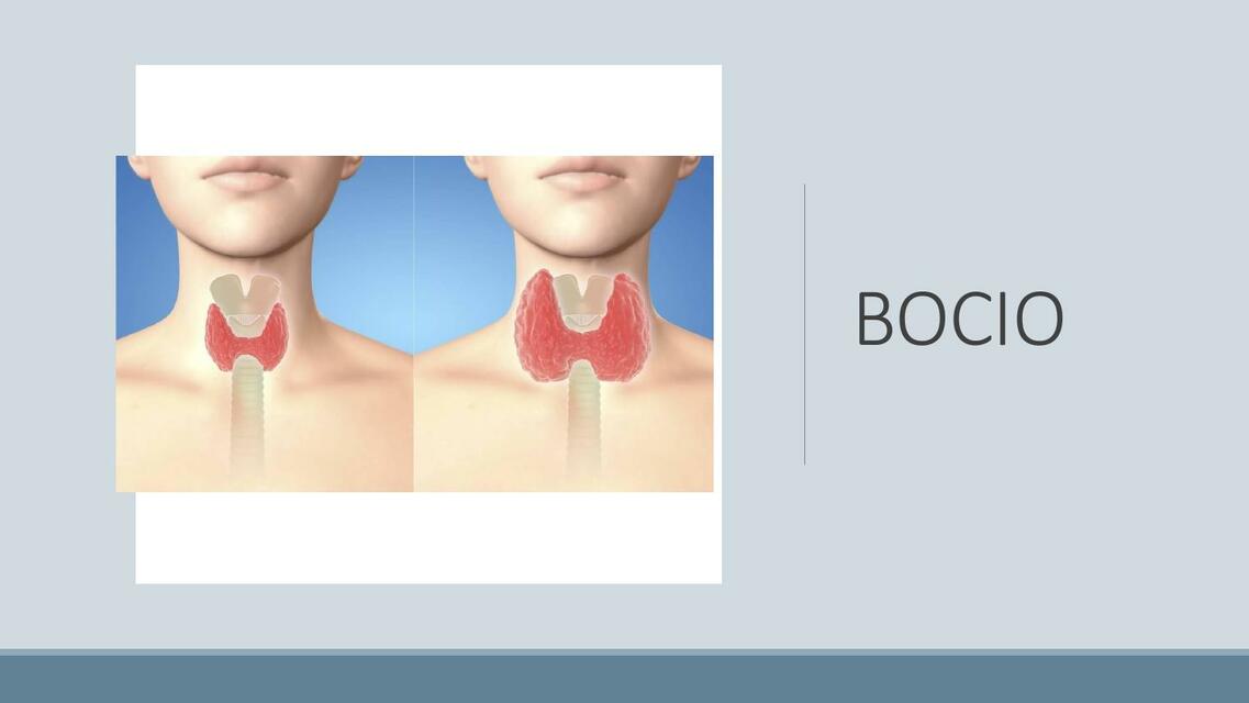 Flashcards de Bocio y Nódulo Tiroideo | Por Luis Alfonso Flores ...