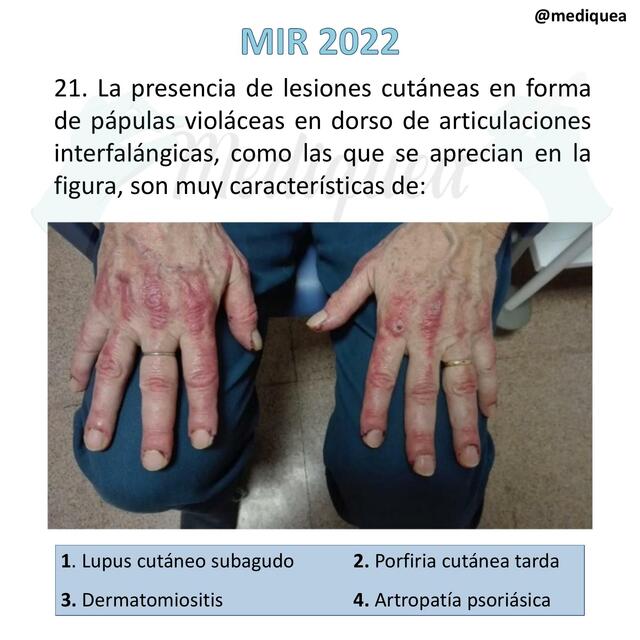 Pápulas de Gottron | Ariel | uDocz