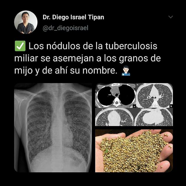 Tuberculosis Miliar | Apuntes Médicos | Diego Israel Tipan, MD ...