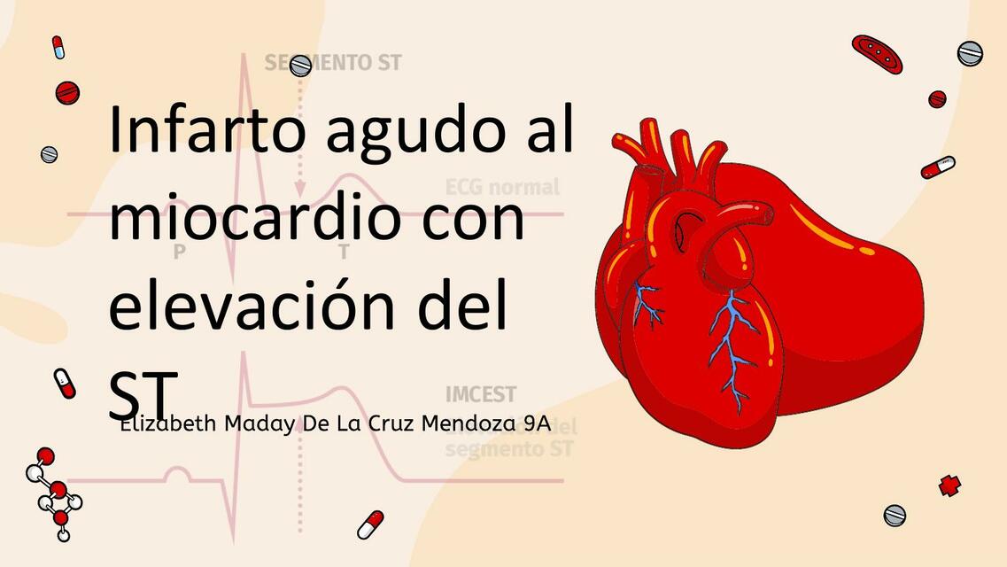 Infarto Agudo al Miocardio | Elizabeth Maday | uDocz