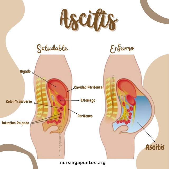Ascitis | Enfermería | uDocz