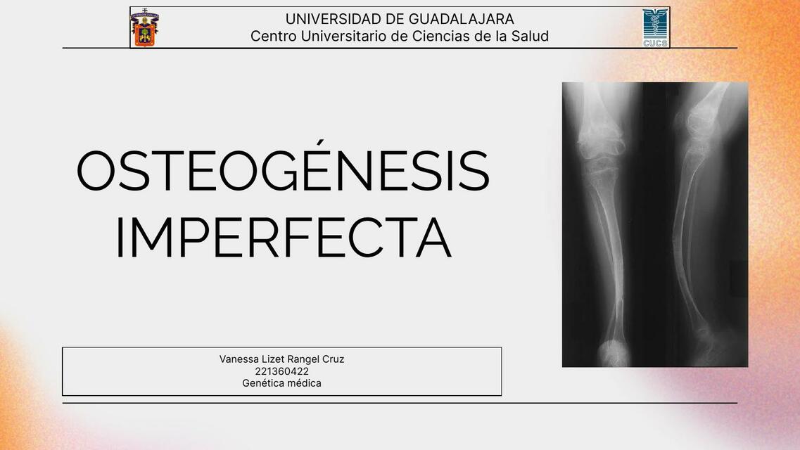 Osteogénesis imperfecta | VANESSA RANGEL | uDocz