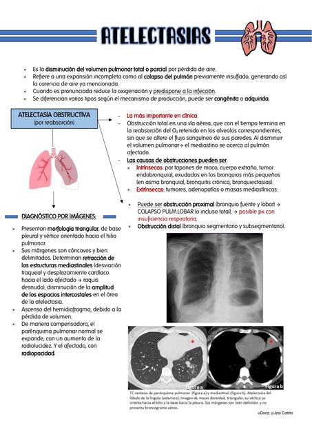 Atelectasia Por Desvio Traqueal Lung Atelectasis | Radiology Case