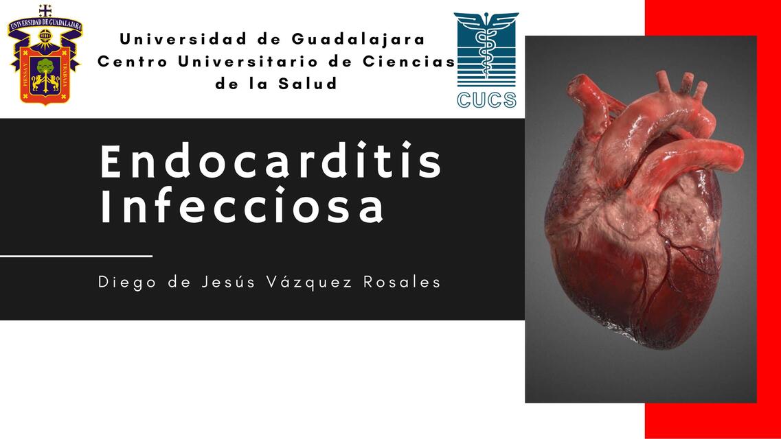 Endocarditis infecciosa | DIEGO VAZQUEZ | uDocz