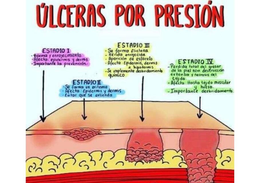 Ulceras por presión | Apuntes | uDocz