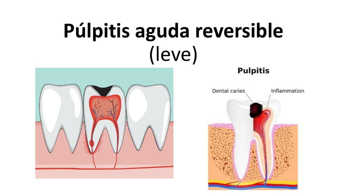 Pulpitis aguda reversible | Abel Lopez | uDocz