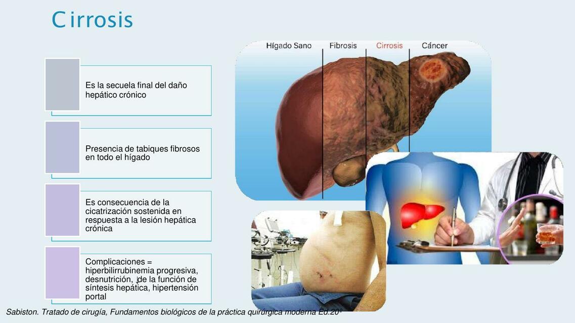 Cirrosis | Medicina Óptima | uDocz