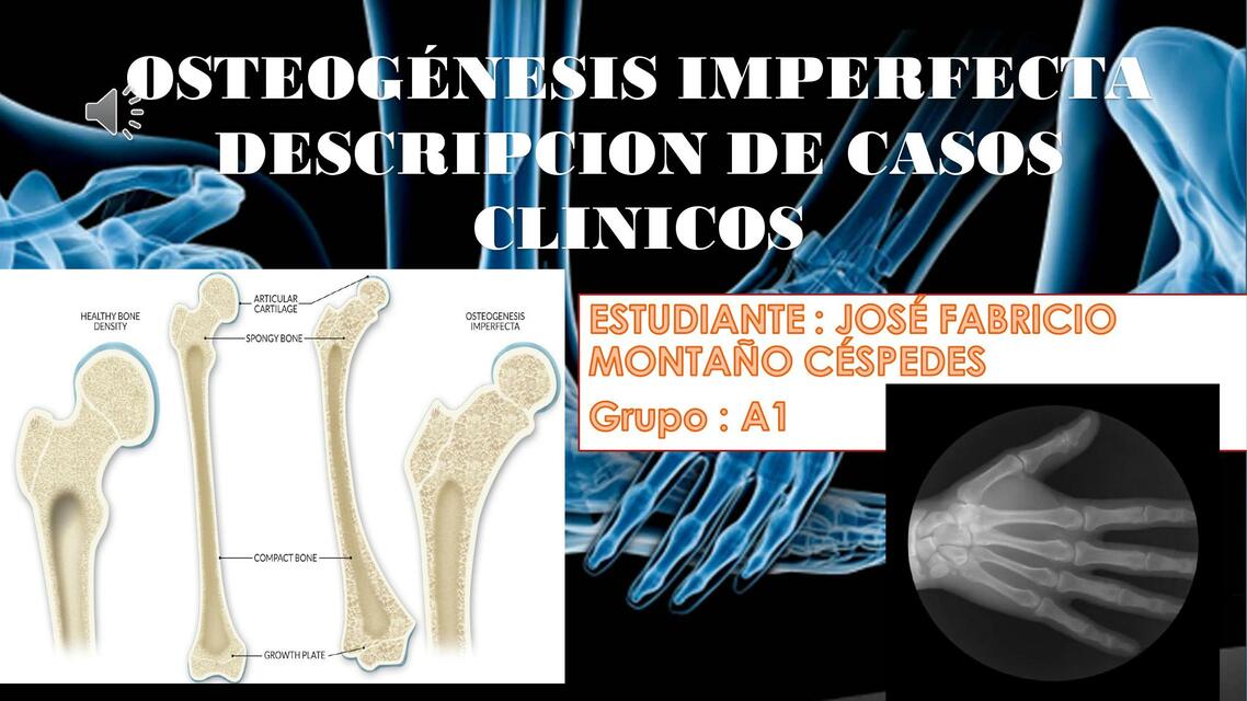 OSTEOGENESIS IMPERFECTA | José Fabricio Montaño Céspedes | uDocz
