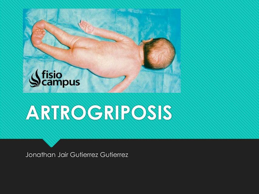 Artrogriposis | JONATHAN JAIR GUTIERREZ GUTIERREZ | uDocz