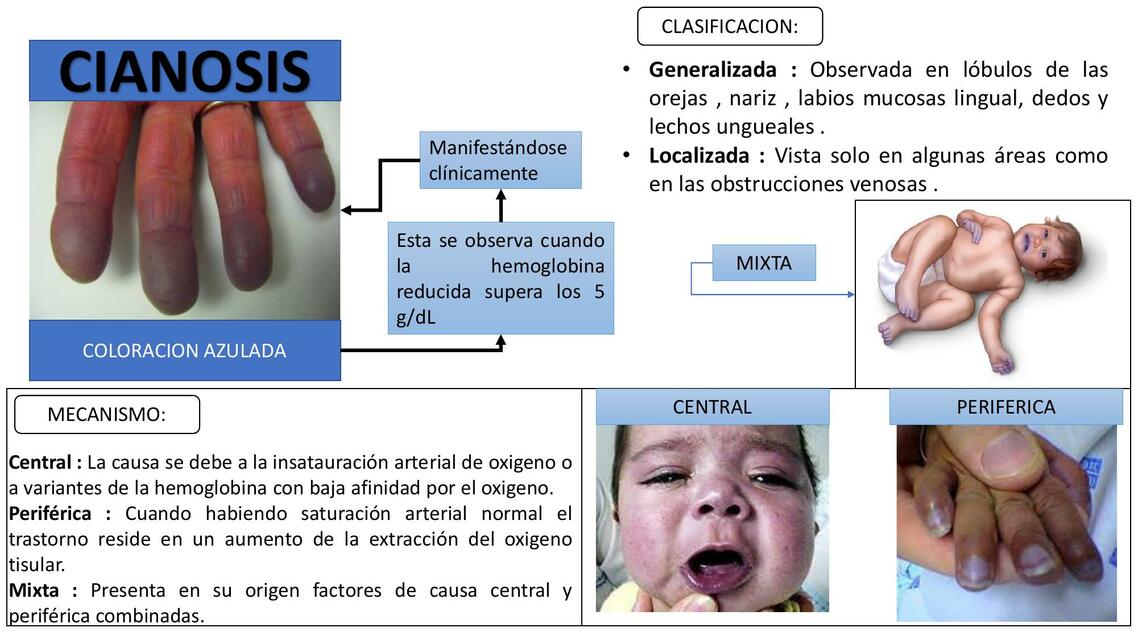 Cianosis y neumotórax | Ediluis | uDocz