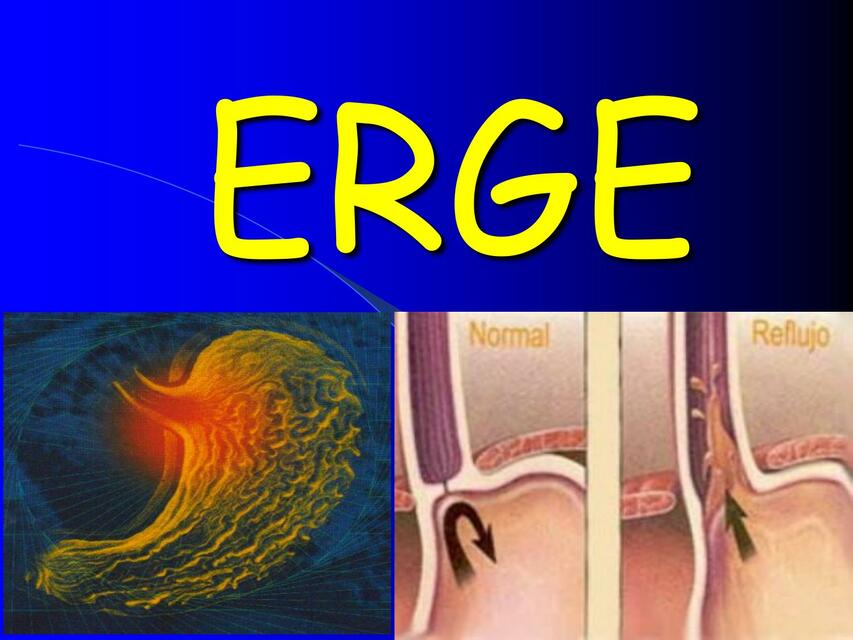 ERGE pirosis odinofagia | Mishelle Chavez | uDocz