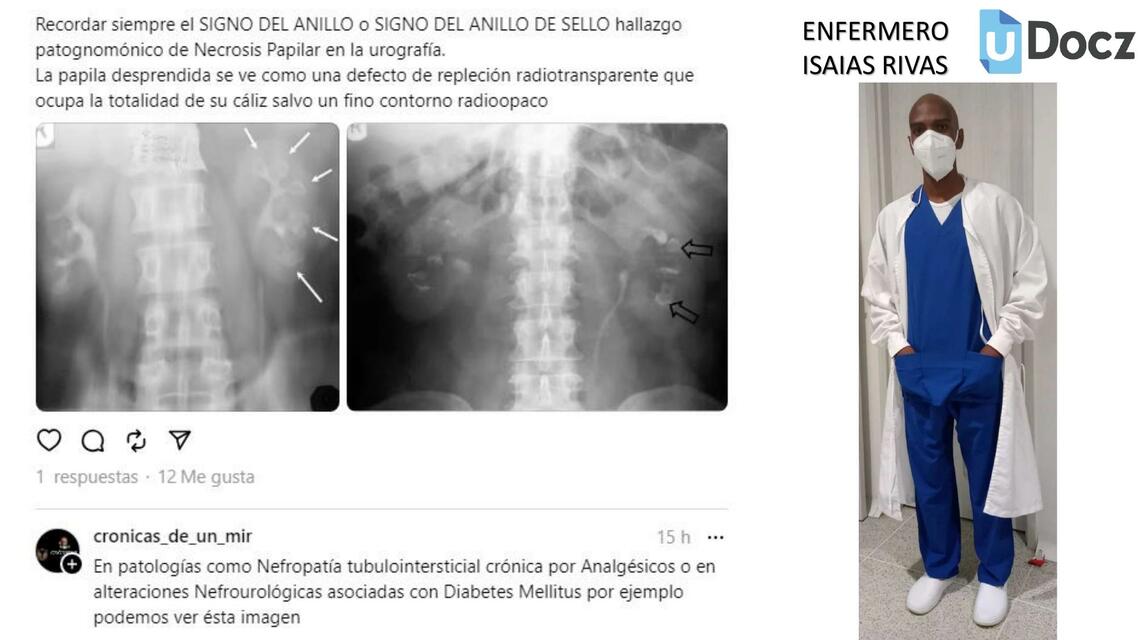 SIGNO DEL ANILLO | Enfermero Isaias Rivas | uDocz