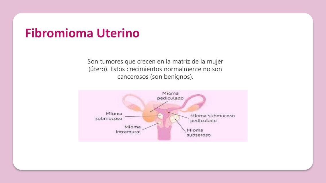 Fibromioma uterino | Escuela medica | uDocz
