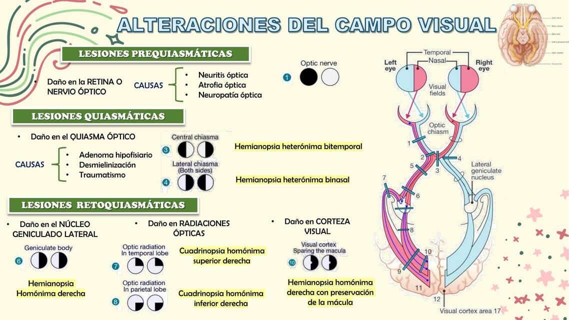 Alteraciones del campo visual Paralisis ocular | Josselin Choquehuanca ...
