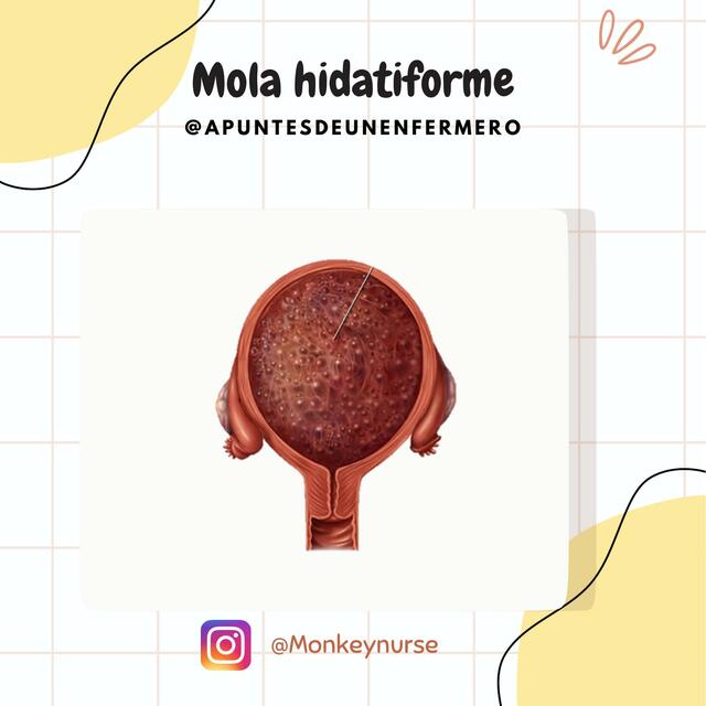 Mola Hidatiforme | MonkeyNurse | uDocz