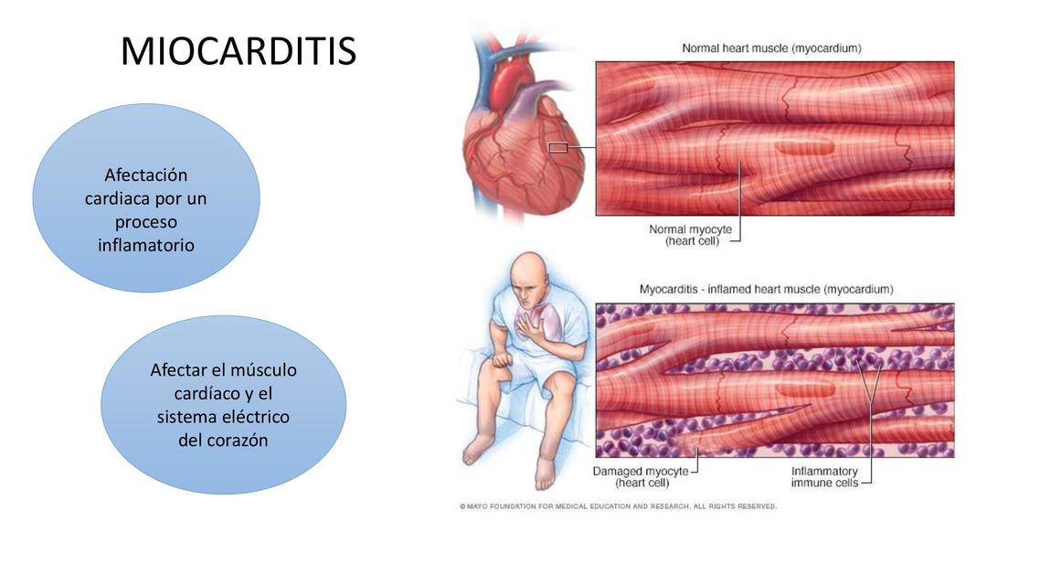 MIOCARDITIS2 | Patricia Chillán | uDocz