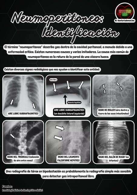 Neumoperitoneo | EntertainMed.Inc | uDocz