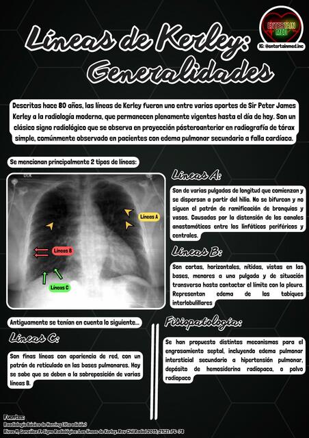 Líneas de Kerley | EntertainMed.Inc | uDocz