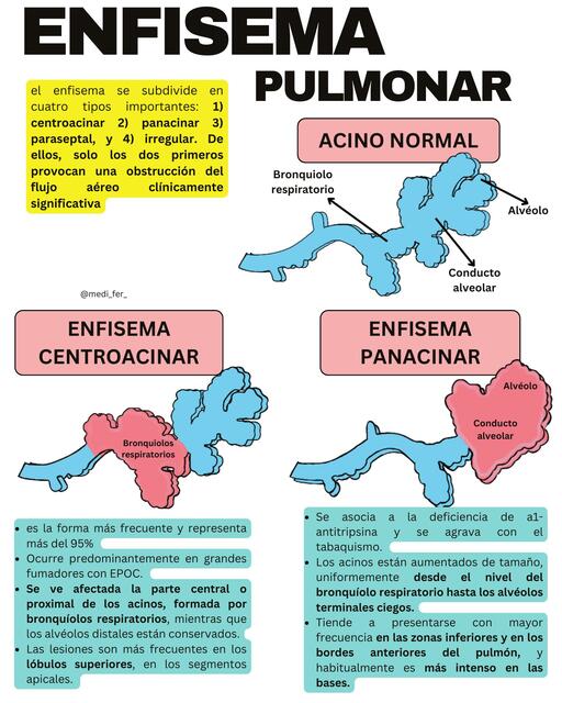 Lámina De Enfisema Pulmonar