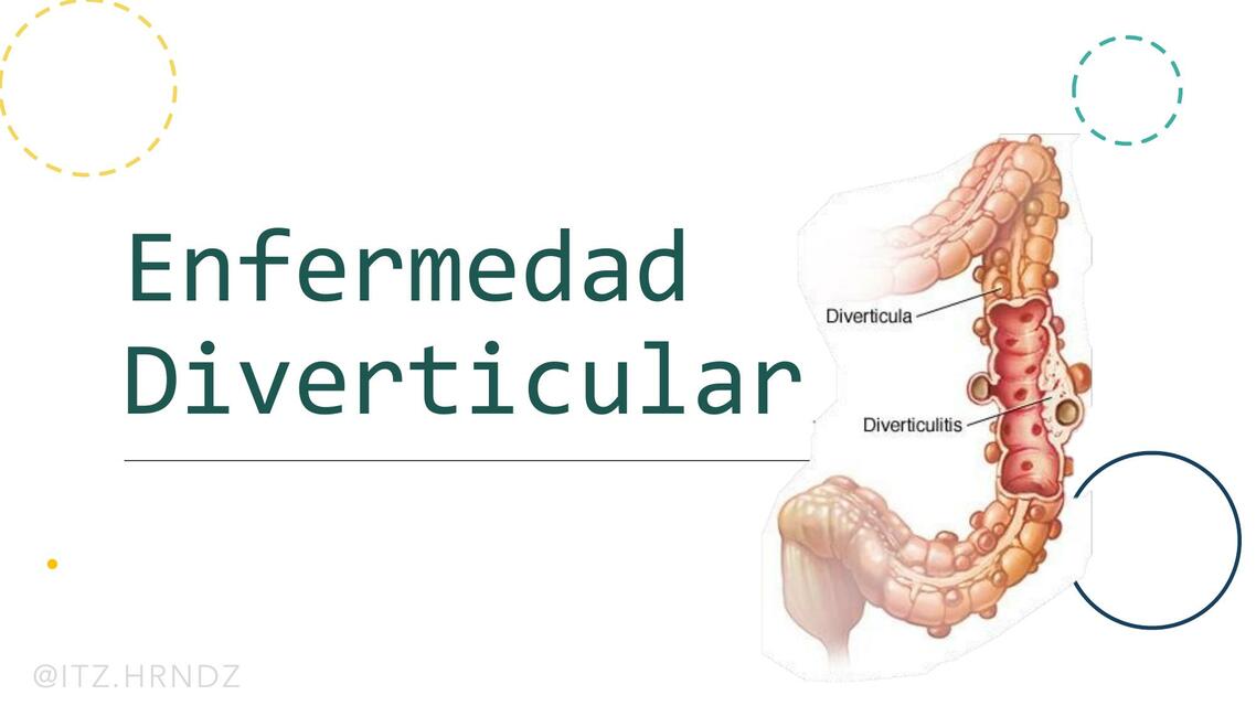 Enfermedad Diverticular | @DraHrndz | uDocz