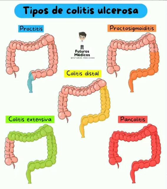 Tipos de colitis ulcerosa | YUDOC.ORG | uDocz