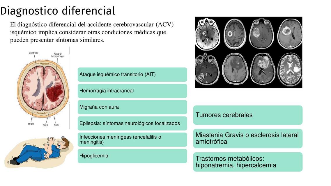 Enfermedad Cerebrovascular Isquemica Diagnostico diferencial | Doctor_teco | uDocz