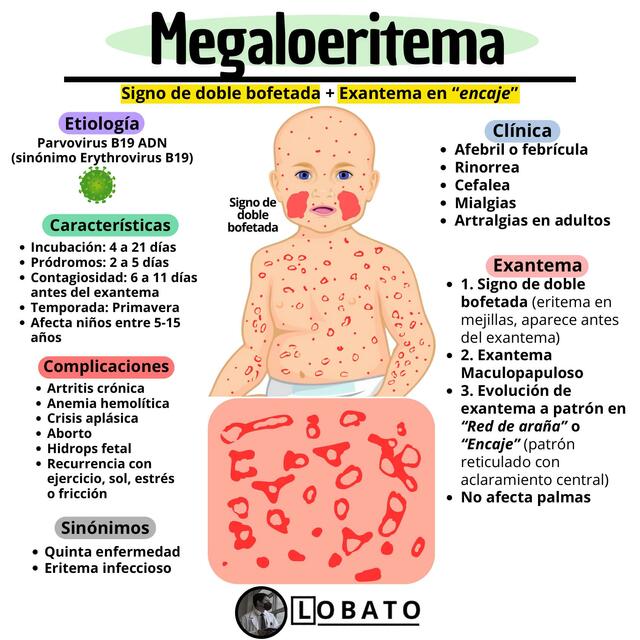Megaloeritema, Quinta enfermedad 🩺| Exantemas Pediatría | Clínica ...