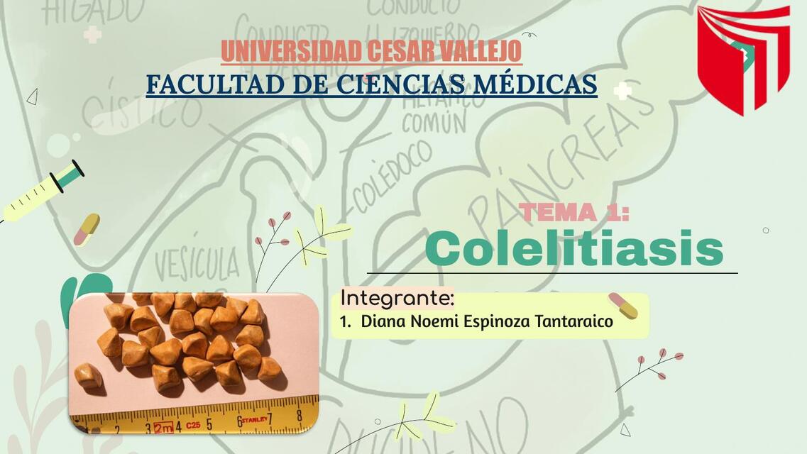 Colelitiasis | Diana Espinoza | uDocz