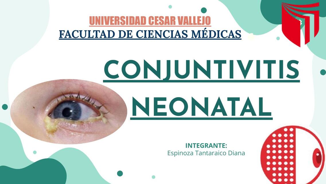 Conjuntivitis neonatal | Diana Espinoza | uDocz