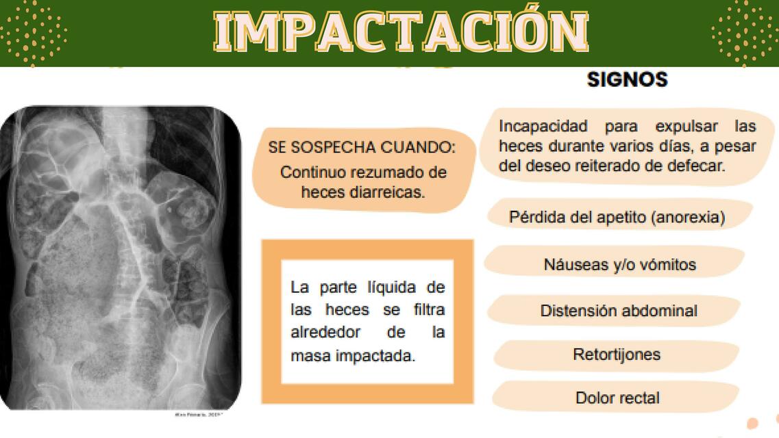 Impactación | MARLEY ROSALIND ELIZAMA VERA BARRETO | uDocz