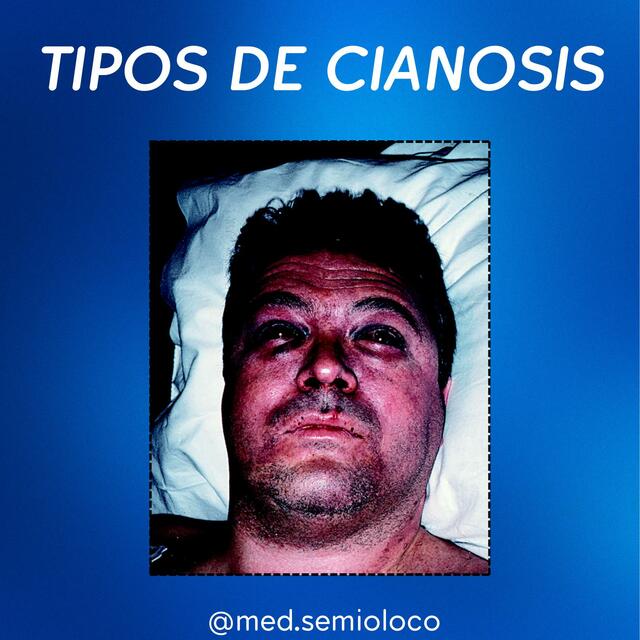Tipos de Cianosis Semiología | Víctor Rodriguez Botero - @med.semioloco ...