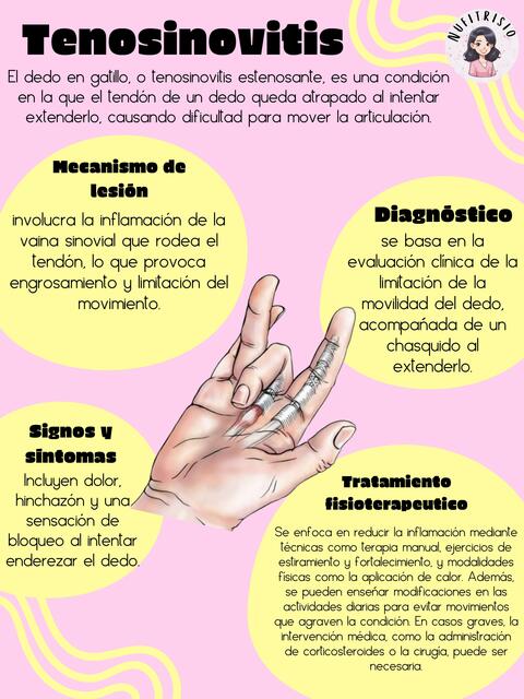 El dedo en gatillo o tenosinovitis estenosante | Nufitrisio | uDocz