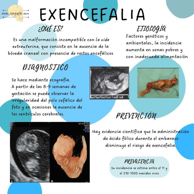 Exencefalia | Fisio.Ada | uDocz