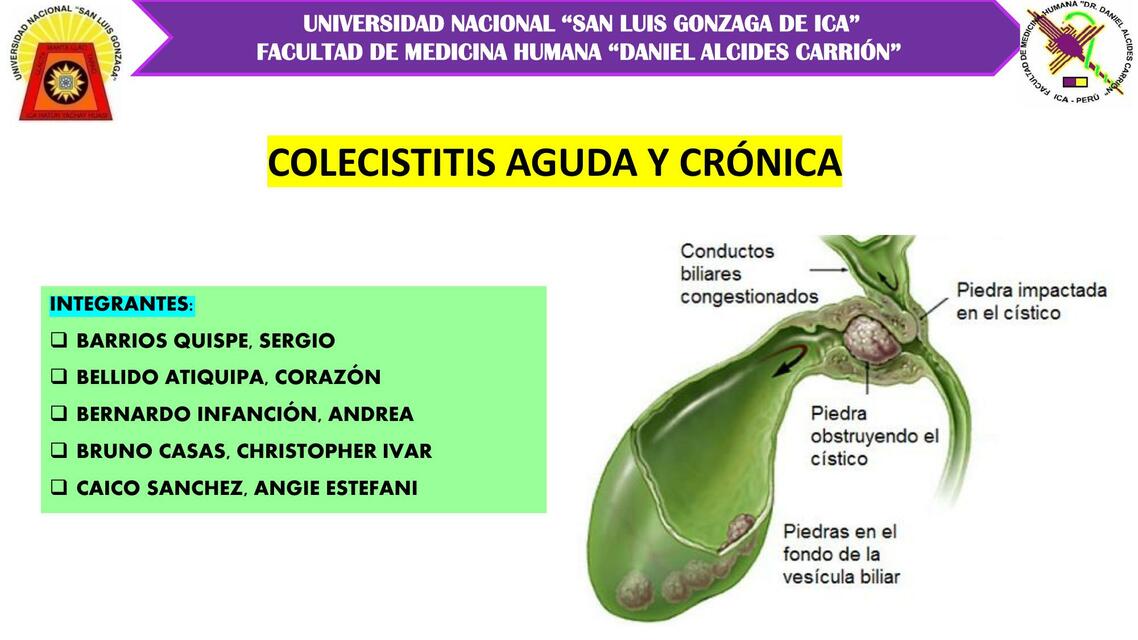 Colecistitis aguda y crónica | Mabel Pariona Chuñocca | uDocz