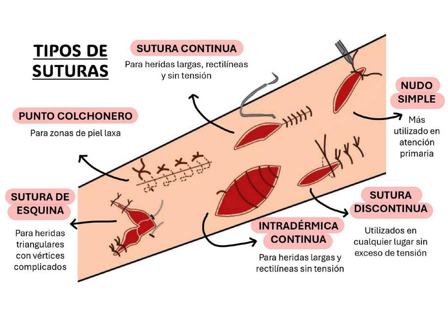 Tipos de suturas | Camila Silva | uDocz