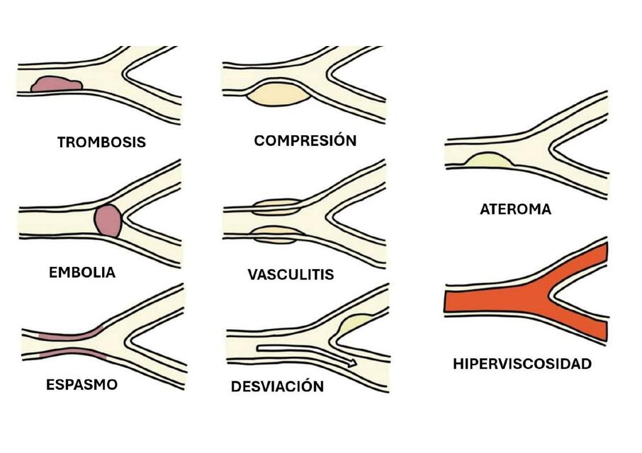 Trombosis embolio | Camila Silva | uDocz