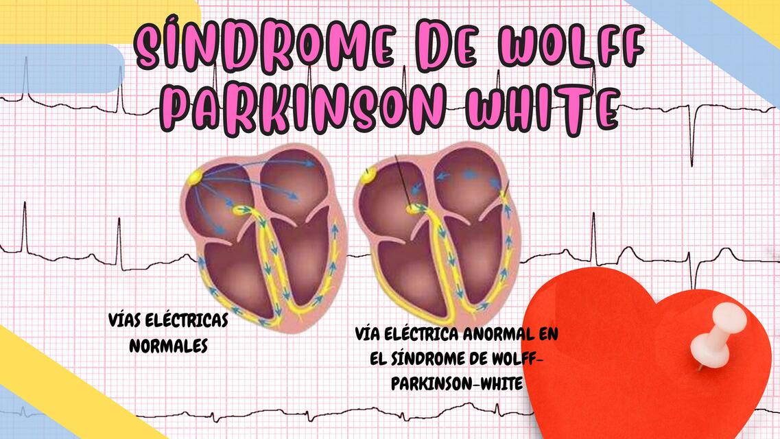 Síndrome de Wolff parkinson white | MARLEY ROSALIND ELIZAMA VERA ...