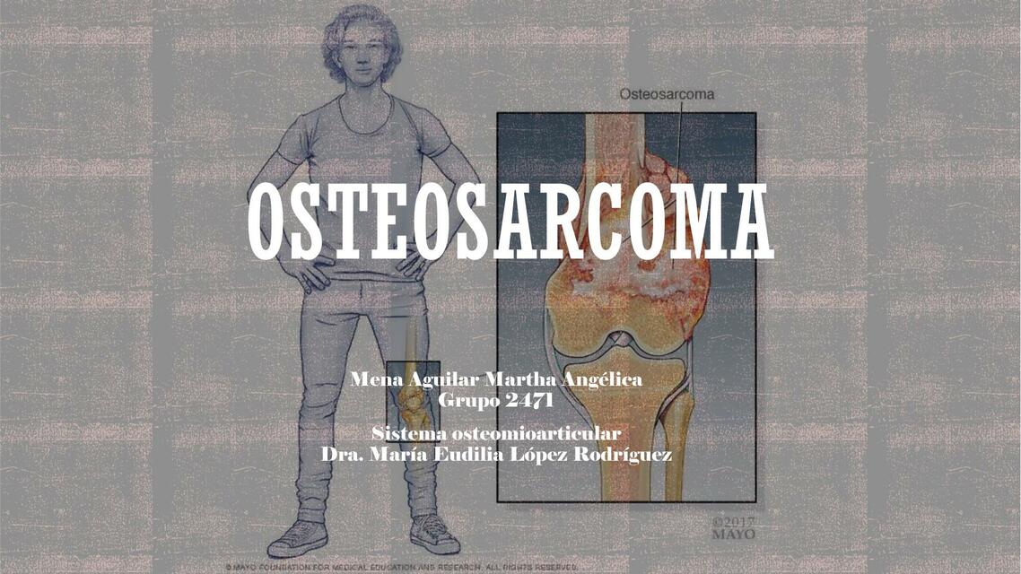Osteosarcoma | Angélica Mena | uDocz