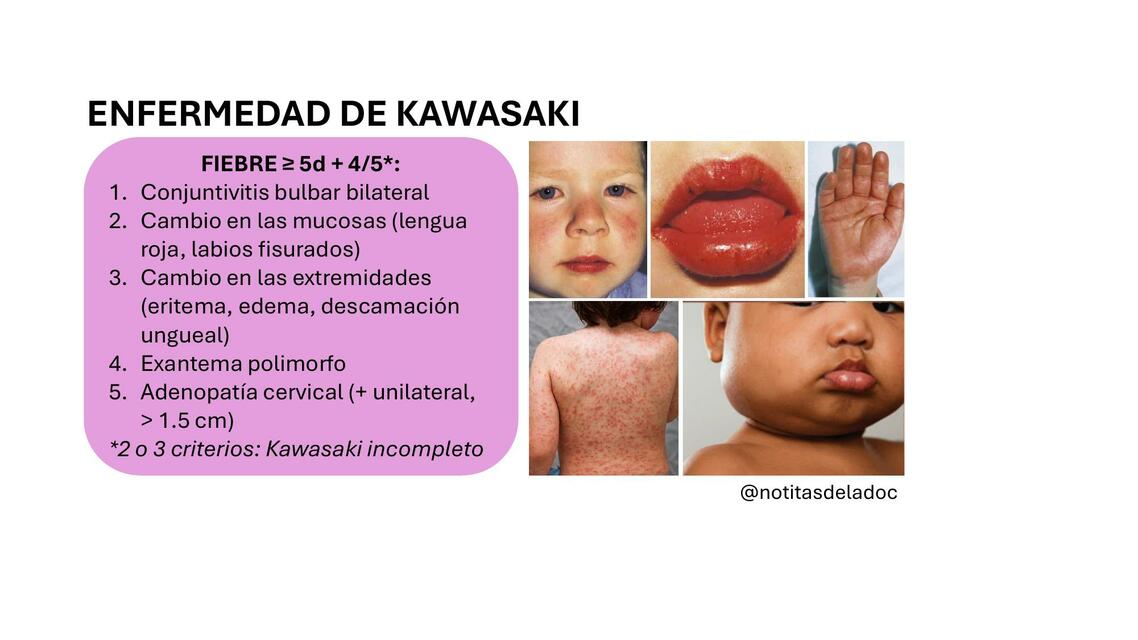 Enfermedad de Kawasaki | LaDoc | uDocz