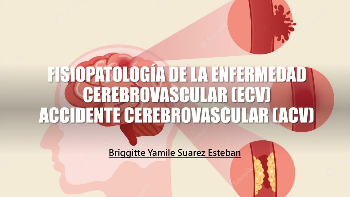 FISIOPATOLOGÍA ACCIDENTE CEREBROVASCULAR EN ESQUEMAS | Briggitte Yamilé Suarez Esteban | uDocz