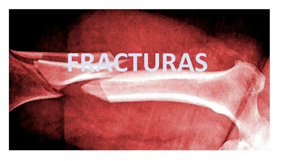 Fracturas | Aida NursNotes | uDocz