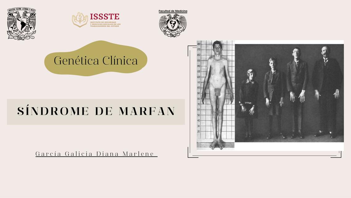 Síndrome de Marfan | Jessy González | uDocz