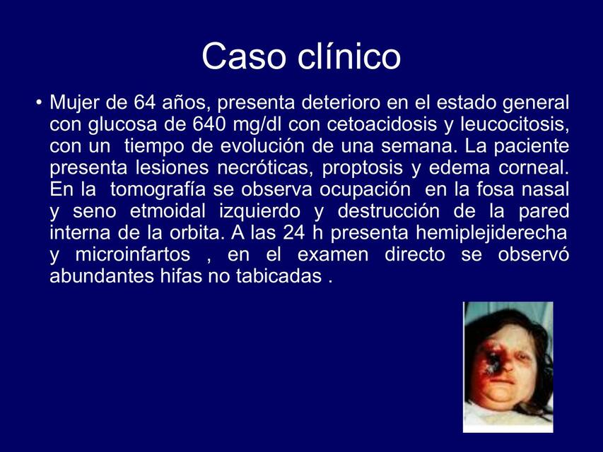 Zigomicosis | IOVANNY CRUZ OJEDA | uDocz